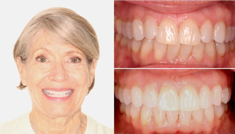 Austin Invisalign Before and After Pictures | Kunik Orthodontics