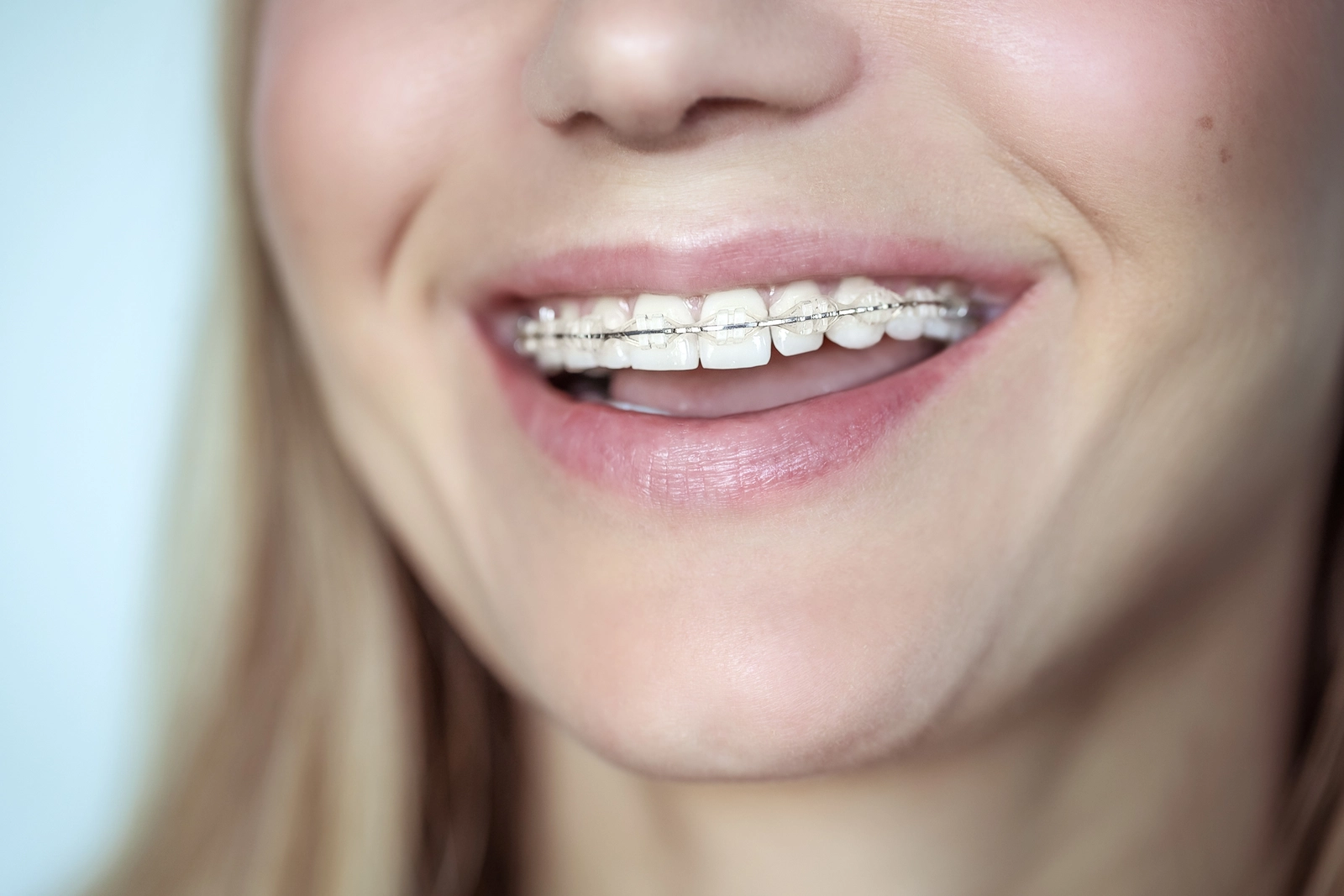 Braces With Wisdom Teeth: Is It Possible?